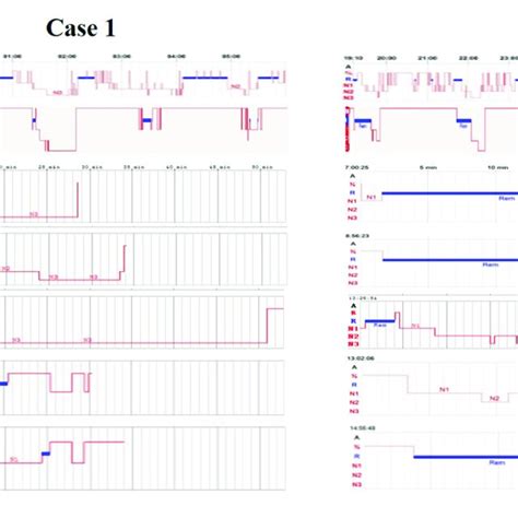 polysomnography and multiple sleep latency tests of the two cases