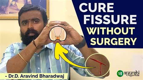 Cure Fissure Without Surgery தமிழ் English Subtitles Dr D