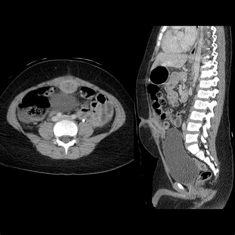 Urachal Cyst