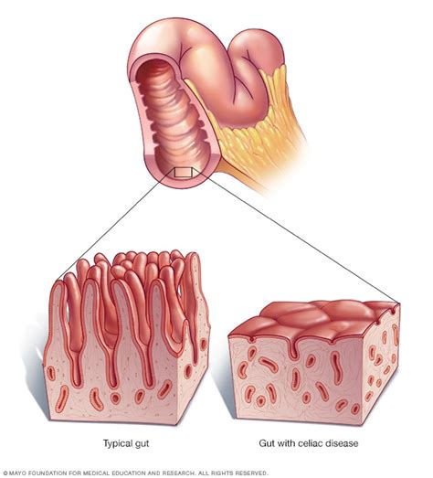 Celiaquía Síntomas Y Causas Mayo Clinic