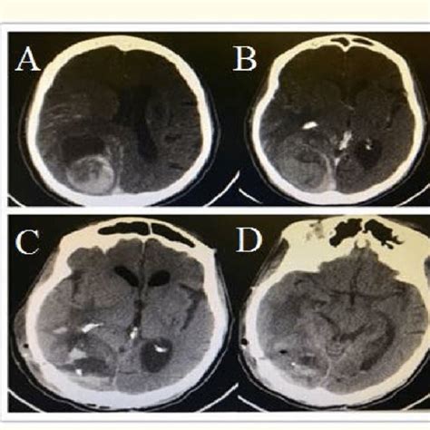 Axial Computerized Tomography Ct A And B Ct Scan In Axial Cut