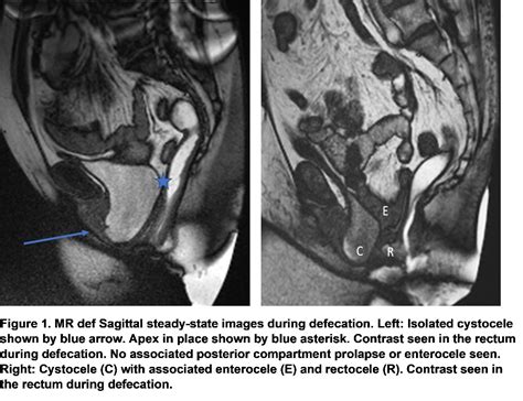 Ics 2021 Abstract 425 Mri Defecography Can Guide The Surgical Planning