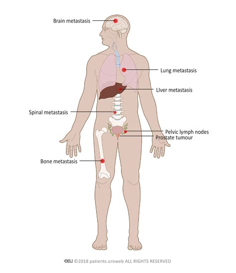 Treatment Of Metastatic Prostate Cancer Patient Information