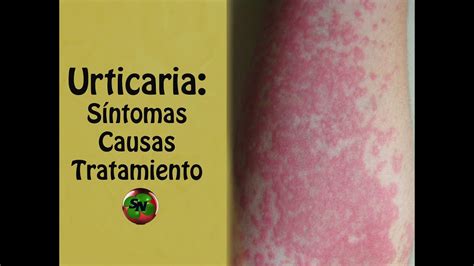 Urticaria Síntomas Causas Tratamiento Y Pronóstico Youtube
