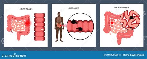 Colon Polyps Cartoon Vector 28712739