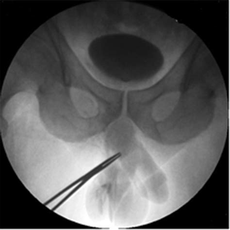 Spermatic Vein Embolization In A Grade Ii Varicocele Syndrome