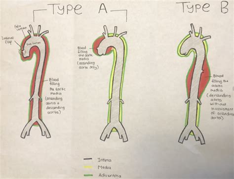 Stanford A Aortic Dissection
