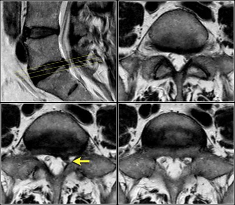 The Radiology Assistant Spine Lumbar Disc Herniation