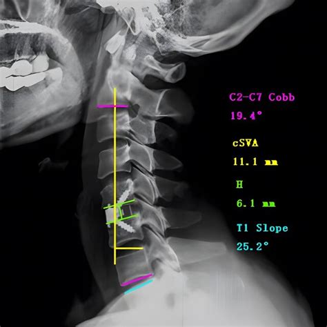 Parameters Defining Cervical Sagittal Alignment And Analysis Example