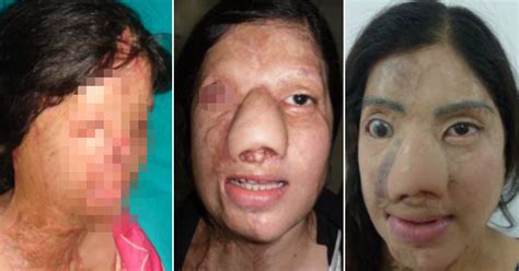 acid attack victim releases before and after pictures of her injuries