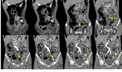 Figure 4 From Laparoscopic Sigmoidectomy For Sigmoid Colon Cancer With