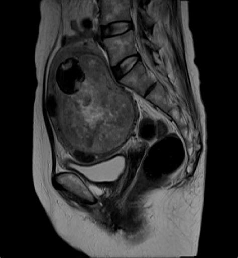 Mr Imaging Showing Significantly Enlarged Uterus With A Heterogeneous