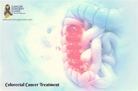 Colorectal Cancer Treatment In Mumbai Dr Ganesh Nagarajan Medium
