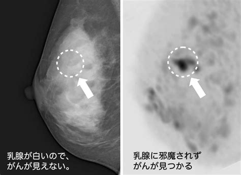 乳がんの初期症状「しこり」と「しこりのできない4つの乳がん」はセルフチェックと定期検診で早期発見しよう（医師監修） まめクリニック（新宿