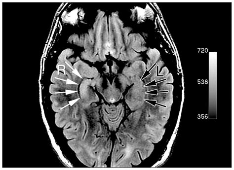 Mesial Temporal Sclerosis In Epilepsy Cmaj