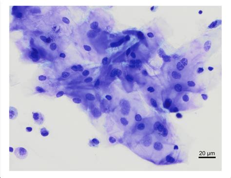 Oropharyngeal Contamination Of A Bronchoalveolar Lavage From A