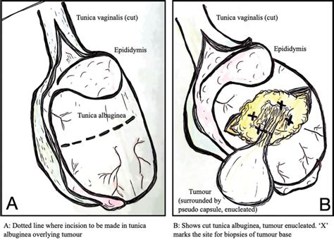 Figure 1 Partial Orchidectomy Surgical Technique For Excision Of Tumor