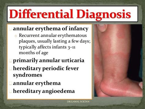 Annular Erythema