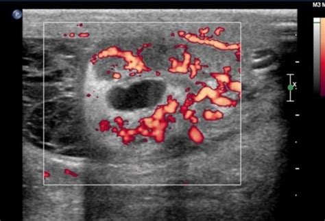 Testicular Abscess Radiology Case Diagnostic