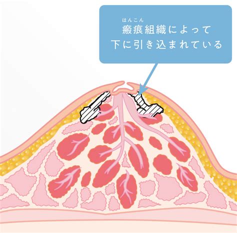 陥没乳頭【保険適用】新しい切らない手術法 原因とリスク 横浜市鶴見の形成・美容外科 エムズクリニック