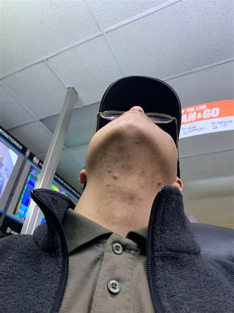 [acne] My Routine For Getting Rid Of Mild Body Acne Bacne And Fading