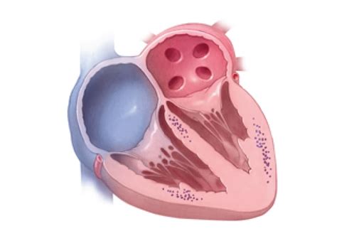 Cardiac Sarcoidosis Stages