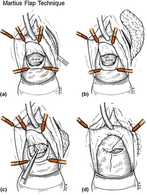 Surgical Repair Of Rectovaginal Fistulas In Patients With Crohns