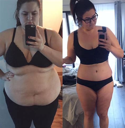 Sleeve Gastrectomy Before And After Skin