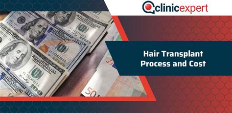 Hair Transplant Procedure And Cost Clinicexpert