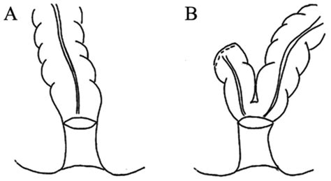 Efficacy Of Side‑to‑end Anastomosis To Prevent Anastomotic Leakage