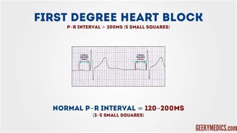 How To Read An Ecg Ecg Interpretation Ekg Geeky Medics