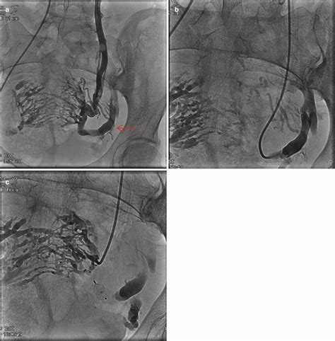 Varicocele And Pelvic Congestion Syndrome Radiology Key