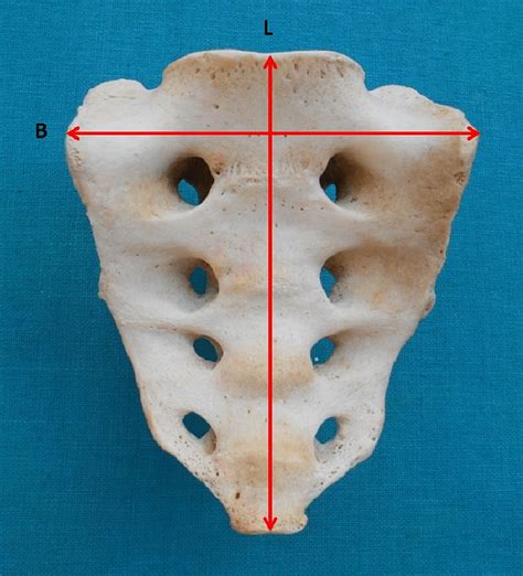 Cureus Determination Of Sexual Dimorphism Of The Human Sacrum Based