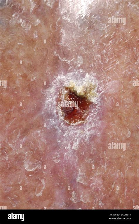 Basal Cell Carcinoma Close Up Of A Raised Bleeding Ulcer Like Growth
