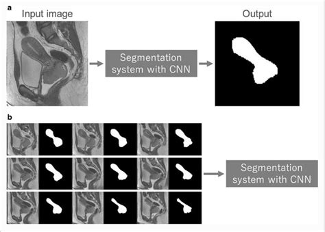 convolutional neural networks an overview and application in radiology