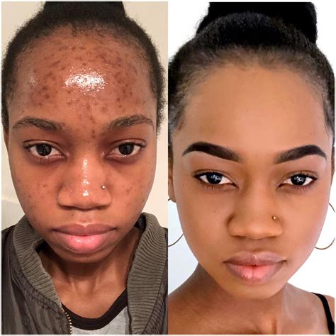 When People Compliment How “flawless” My Skin Is Meanwhile💀 I Think I