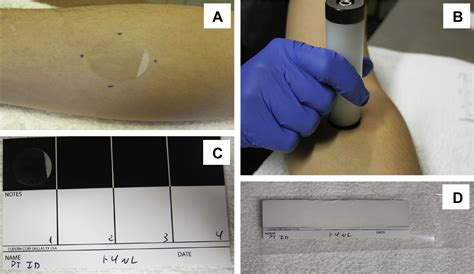Skin Tape Sampling Technique Identifies Proinflammatory Cytokines In