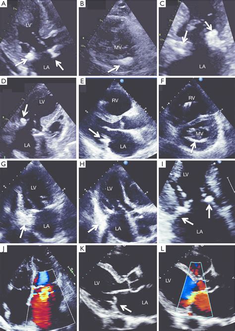 Four Different Examples Of Patients With Mitral Annular Calcification