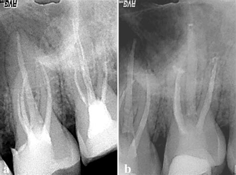Periapical Radiographs Tooth Number 27 A Before The Treatment B