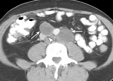 Mesenteric Lymph Nodes Seen At Imaging Causes And Significance