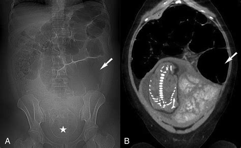 Sigmoid Volvulus In Pregnancy Journal Of Emergency Medicine