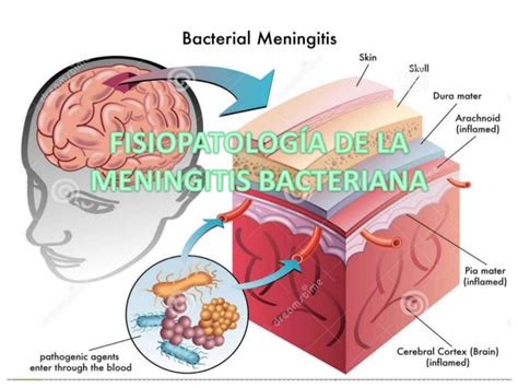 Fisiopatologia De La Meningitis Bacteriana Harrison