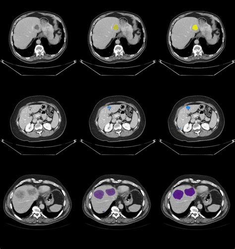 Liver Lesion Segmentation And Classification Results Left Original