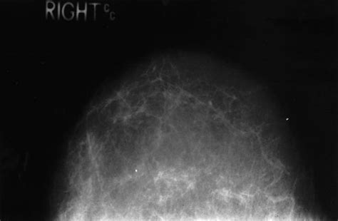 Mammogram Images Normal And Abnormal