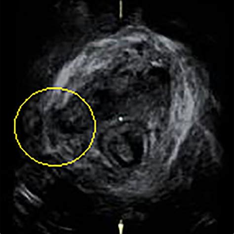 Pdf Diagnostic Value Of Pelvic Floor Ultrasonography For Diagnosis Of