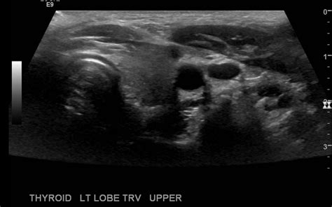 Thyroid Ultrasound Protocol – Sonographic Tendencies