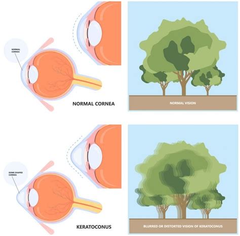 Symptoms Of Keratoconus • Murata Eyecare Optometry