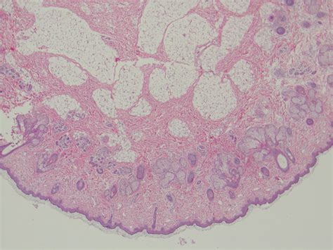 Hairy Polyp Of The Anterior Nasal Cavity Laura J White Bahig M