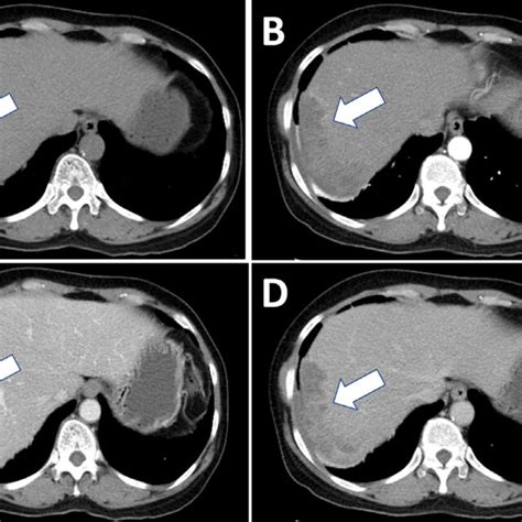 A Ct Scan Revealed That Segment Vii Of The Low Density Liver Mass