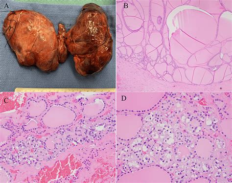 Cureus Multifocal C Cell Hyperplasia And Marked Hypercalcitoninemia
